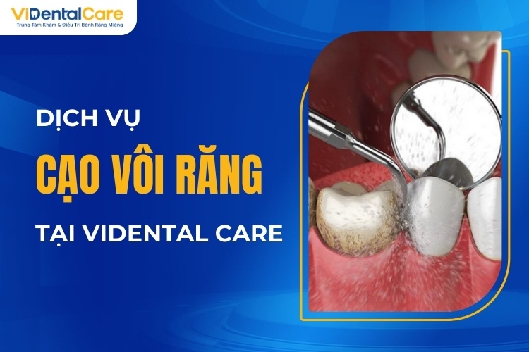 Cạo Vôi Răng Là Gì? Đối Tượng, Quy Trình & Lưu Ý Cần Biết